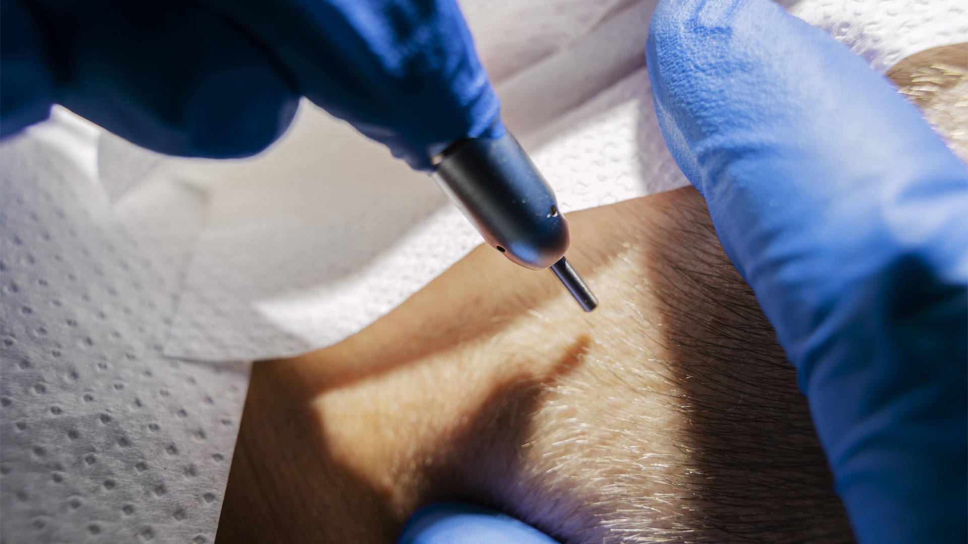 Hair transplant - rimsa